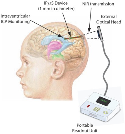 Implantable Biosensors